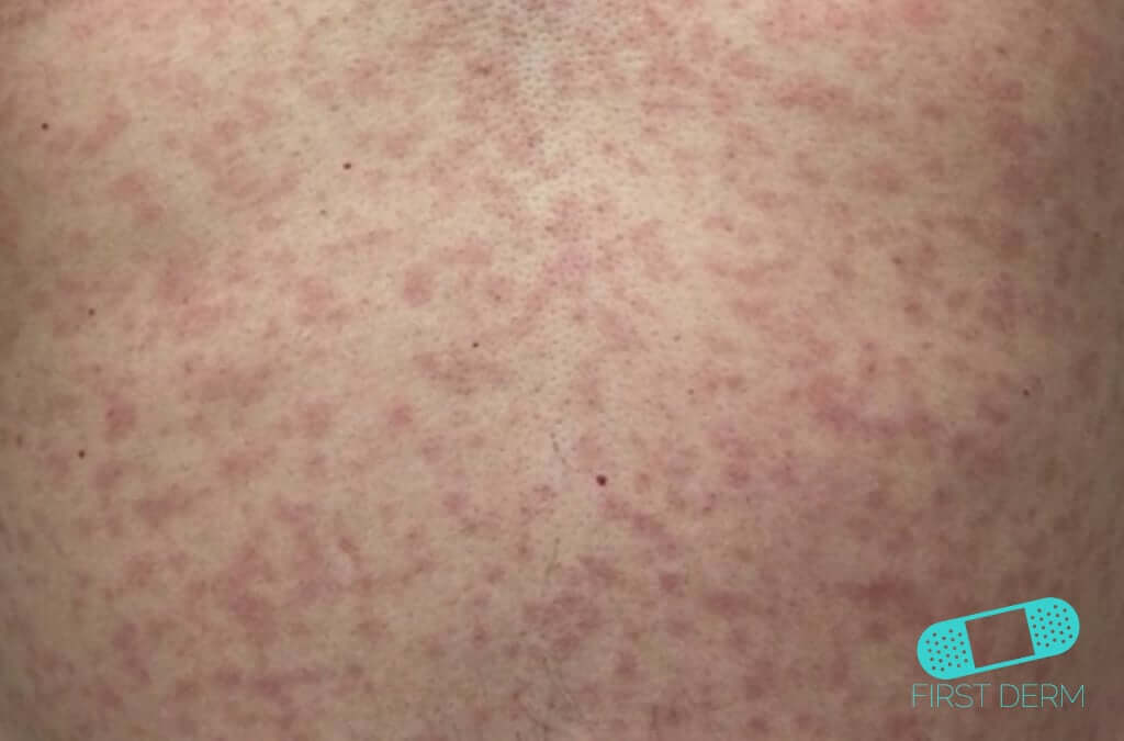 Online Dermatology - Zika Virus (Rash)