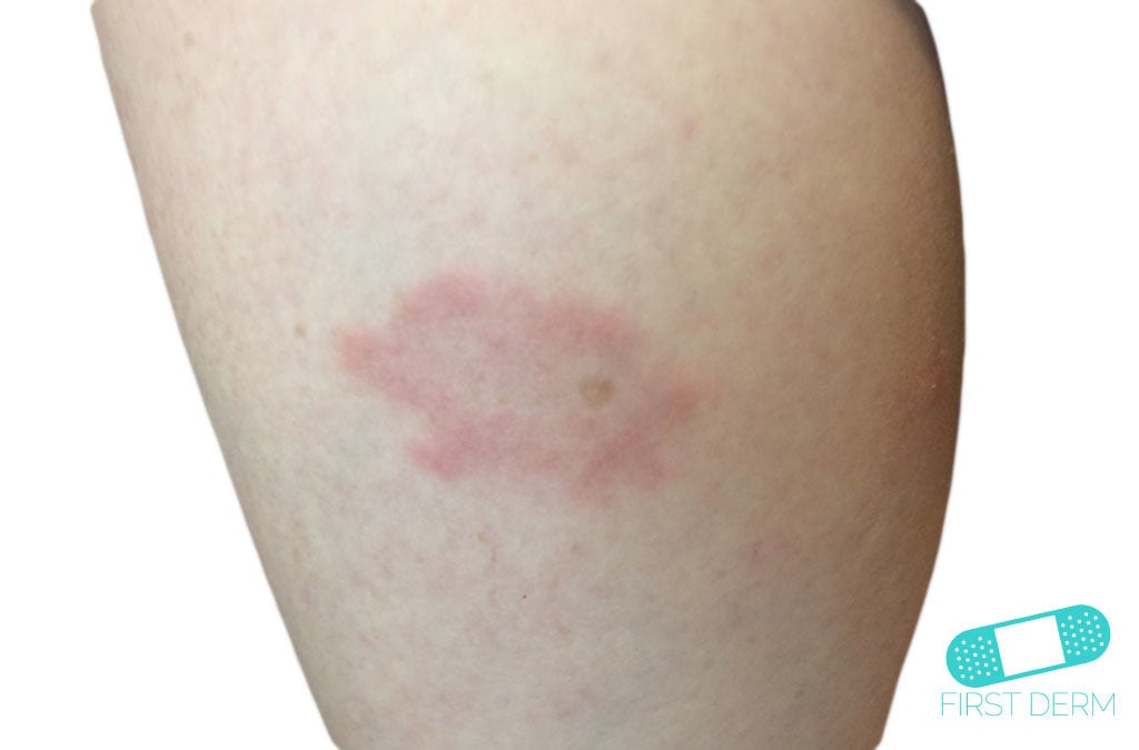 Lyme Disease Symptoms Rash