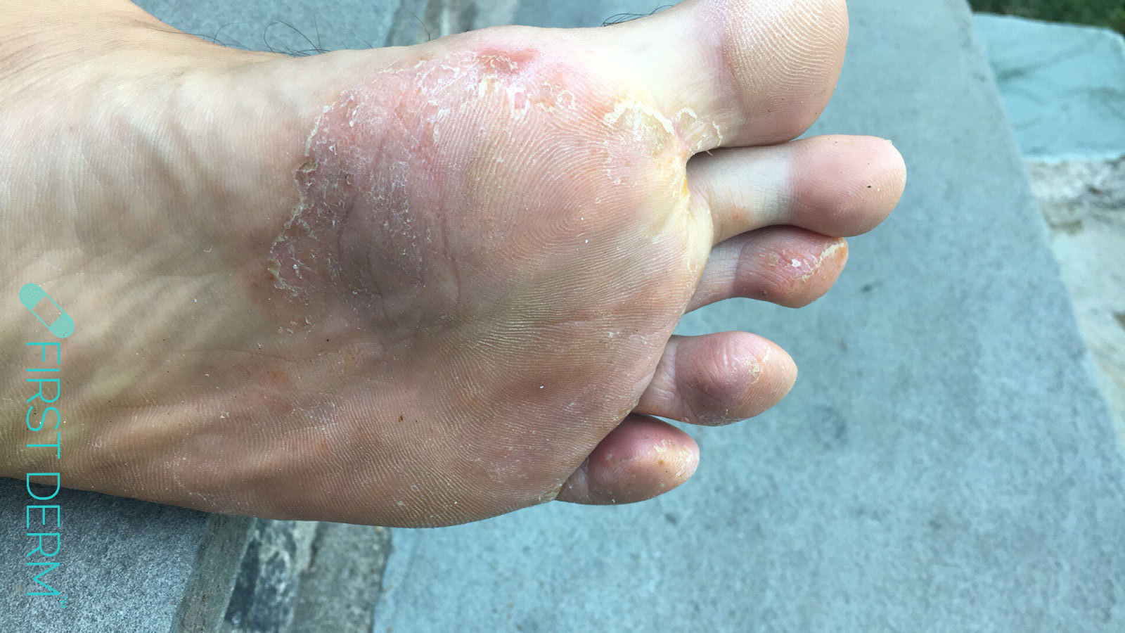 Fotsvamp – Tinea Pedis – diagnos, symptom och behandling - Hudläkare