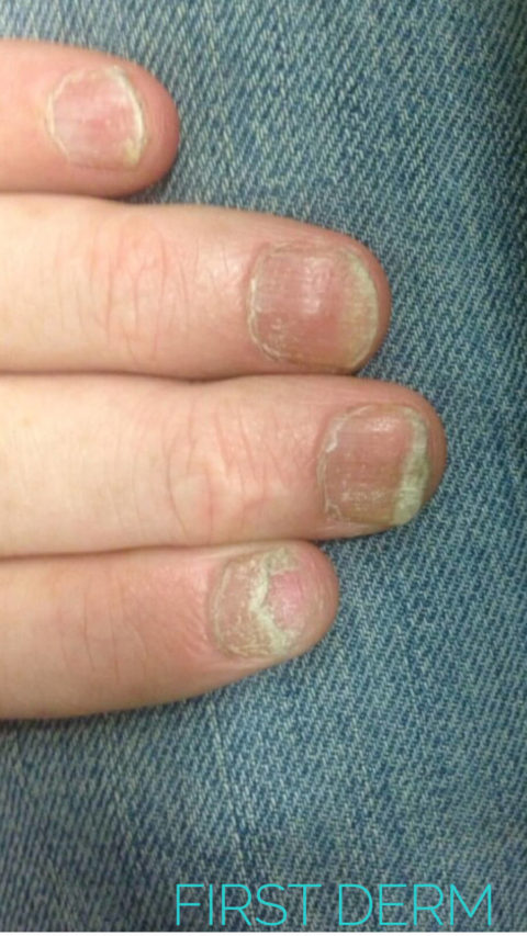 Common nail discoloration | First Derm