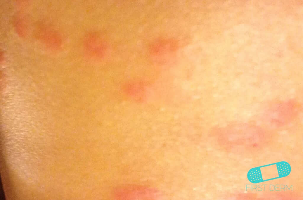 Pityriasis Rosea Online Dermatology Pityriasis Rosea Online Dermatology
